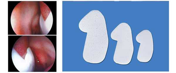 Internal Nasal Splints - Ace Medical Co